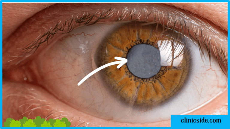 Cataract Causes, Signs & Symptoms, Diagnosis Treatment